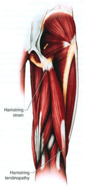 Hamstring Muscle Tear